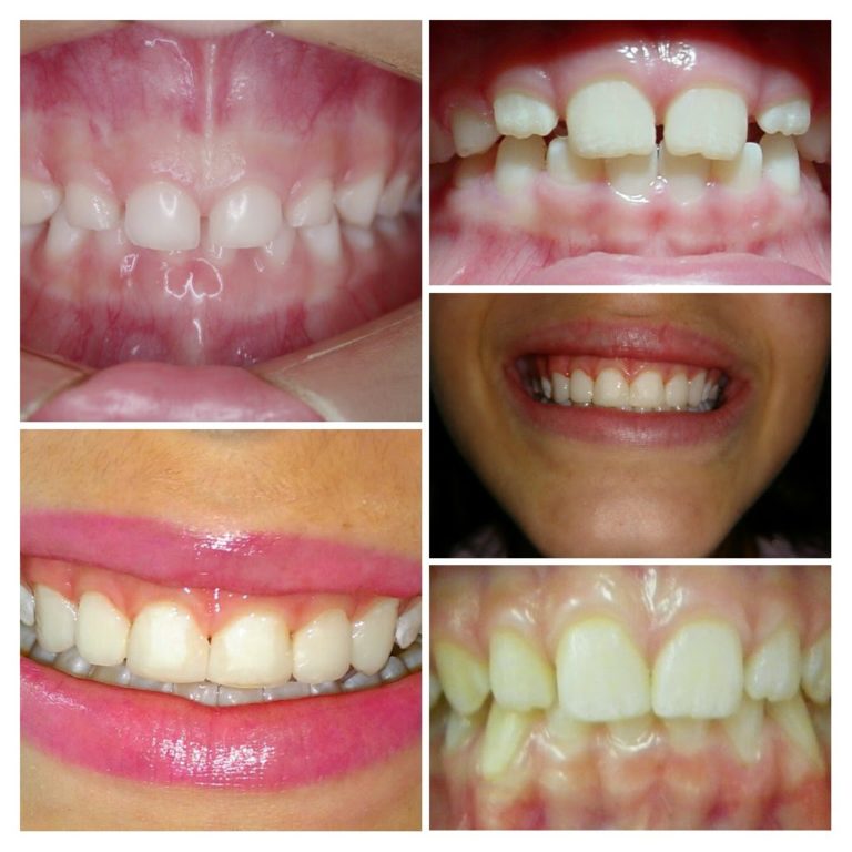 Ortopedia Funcional dos Maxilares - Biociberbucal